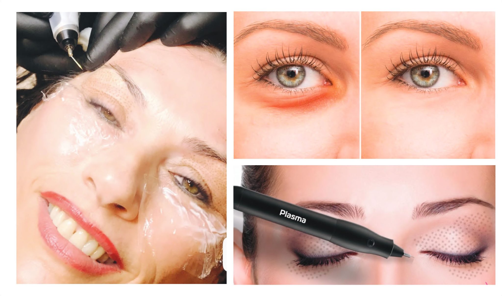 Plasma Pen Services in Thousand Oaks, Moorpark, Westlake Village CA